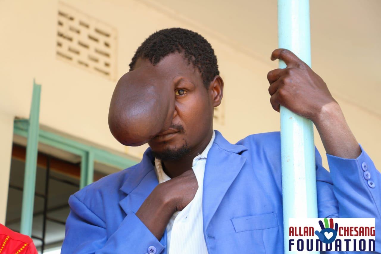 A BRIEF UPDATE ON A SUCCESSFUL SURGERY – Allan Chesang Foundation